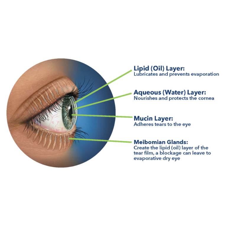 Dry Eye Disease - Redmond Eye Clinic Dry Eye Disease - Redmond Eye Clinic